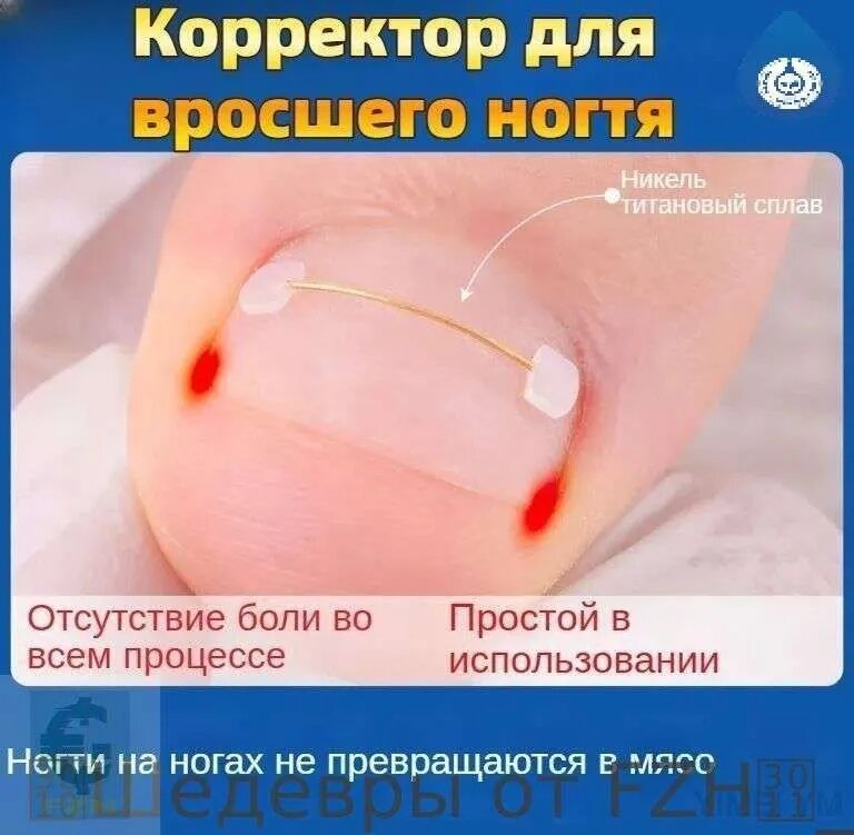 Комплект из 8 никелид-титановых корректоров для вросших ногтей