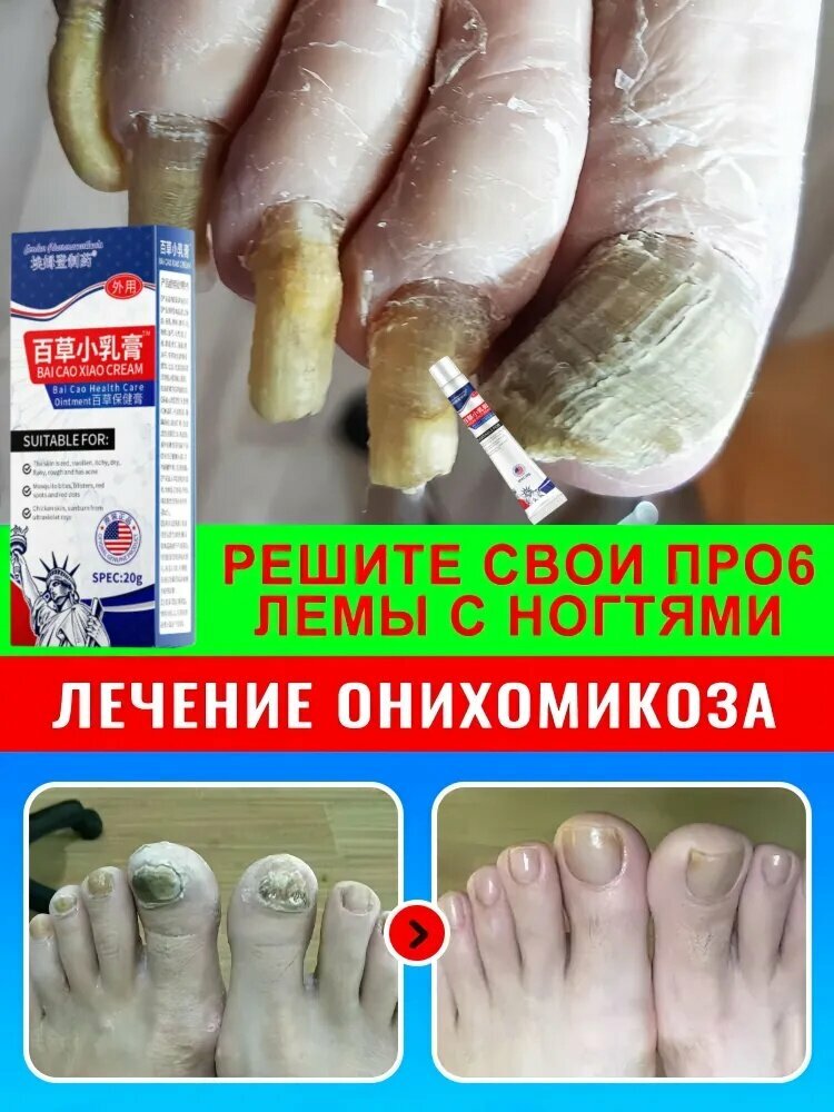 Крем от грибка ногтей, китайская чудо-мазь, эффективное противогрибковое средство, 20 г