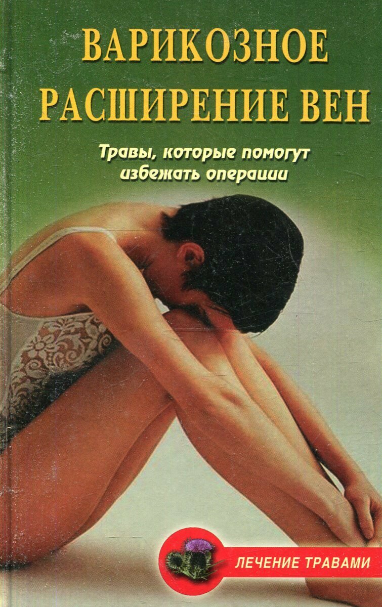 Варикозное расширение вен. Травы, которые помогут избежать операции