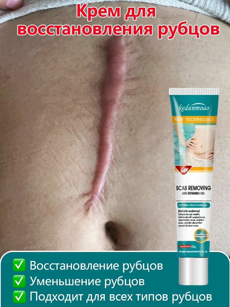 Крем для восстановления рубцов/20 г/Эффективно удаляет шрамы от акне, растяжки, ожоги и послеоперационные рубцы Мягкий и не раздражающий кожу делает её гладкой