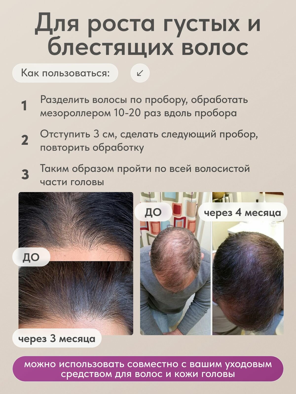 Мезороллер 1мм — фото 1