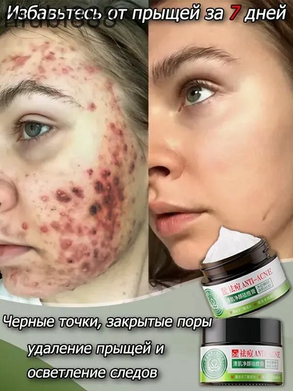 Крем от прыщей для подростков и проблемной кожи, 30 г