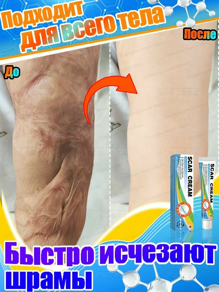 Быстро удаляет хирургические шрамы, ушибы, ожоги, растяжки и шрамы от угревой сыпи; обеспечивает постоянное заживление без побочных эффектов. от шрамов от рубцов для заживления