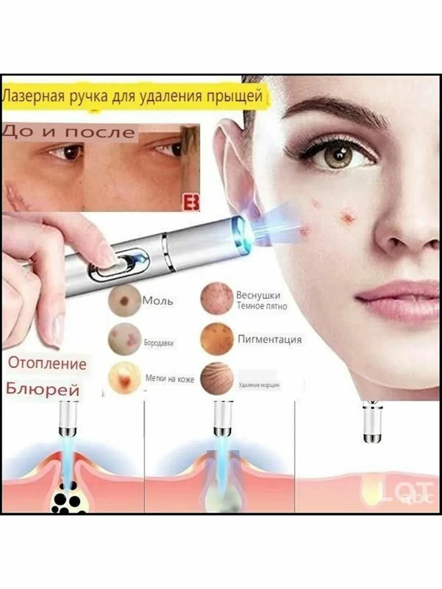 Удаляет пигментные пятна, веснушки, солнечные ожоги, меланодермию, угревую сыпь, морщины. Лазерная указка устраняет пигментацию на лице и теле и отбеливает кожу.1 палочка осветление кожи лазерное удаление пигментации