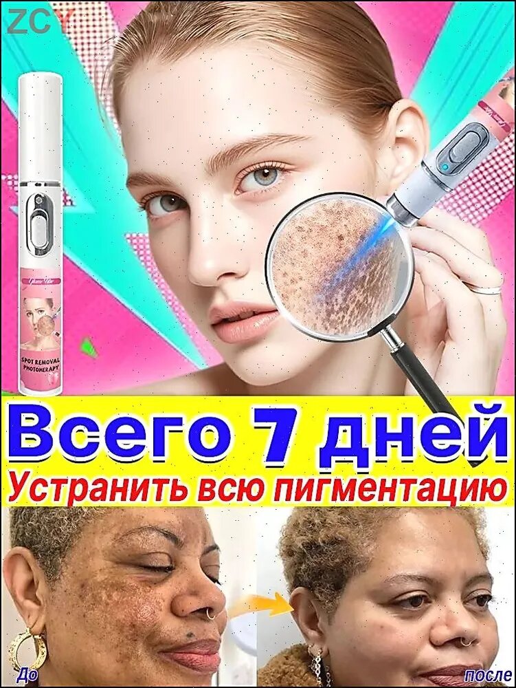 Удаляет пигментные пятна, веснушки, солнечные ожоги, меланодермию, угревую сыпь, морщины. Лазерная указка устраняет пигментацию на лице и теле и отбеливает кожу.1 палочка