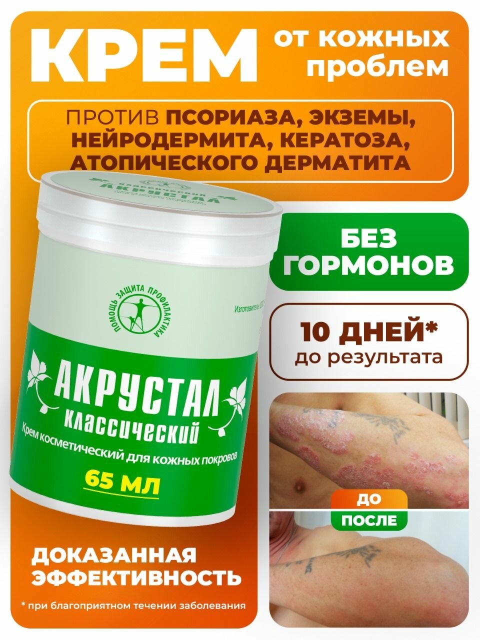 Крем мазь от псориаза экземы и дерматита