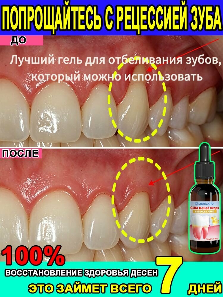 Гель для отбеливания зубов