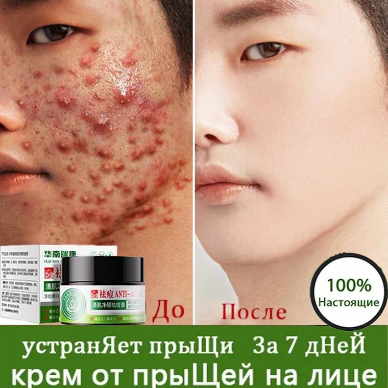 Крем для лица от прыщей от черных точек и угрей, жирной и чувствительной кожи, Снять воспаление на лице для подростков и взрослых 30г
