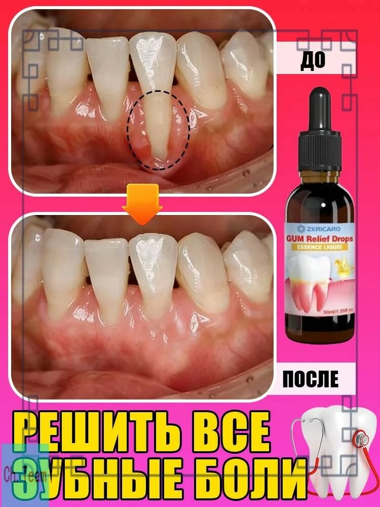 Масло для десен при воспалениях в полости, укрепления дёсен и снижения кровоточивости, Быстро лечит опухшие, лечение пародонтита и гингивита, Чистое дыхание, комплексный уход + защита дёсен,30мл