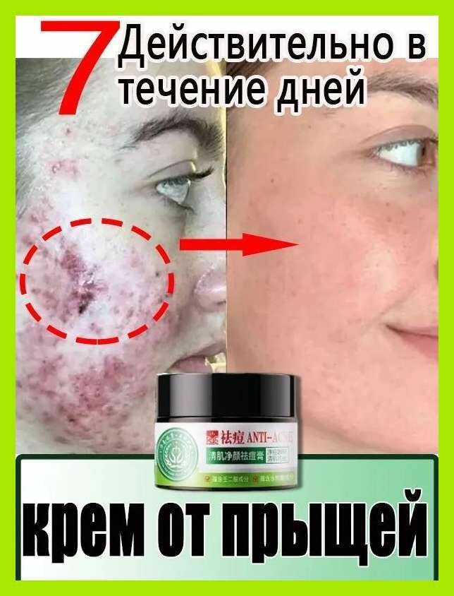 Крем для лица от прыщей и постакне, быстрое заживление, сужение пор и контроль масла, 30 г, для подростков и взрослых
