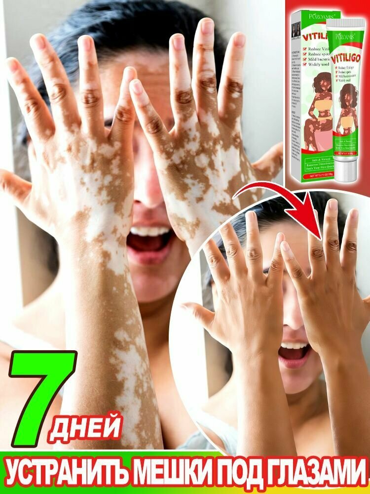 Мазь для лечения витилиго, эффективно удаляет белые пятна и регулирует пигментацию, выравнивает тон кожи и устраняет странные взгляды окружающих, 60 грамм 60г от белых пятен коррекция пигментации
