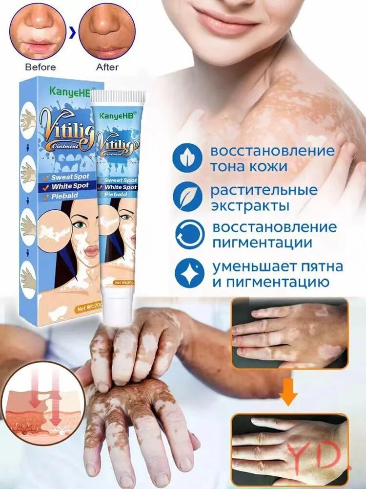 Крем для ухода за кожей с витилиго 20г