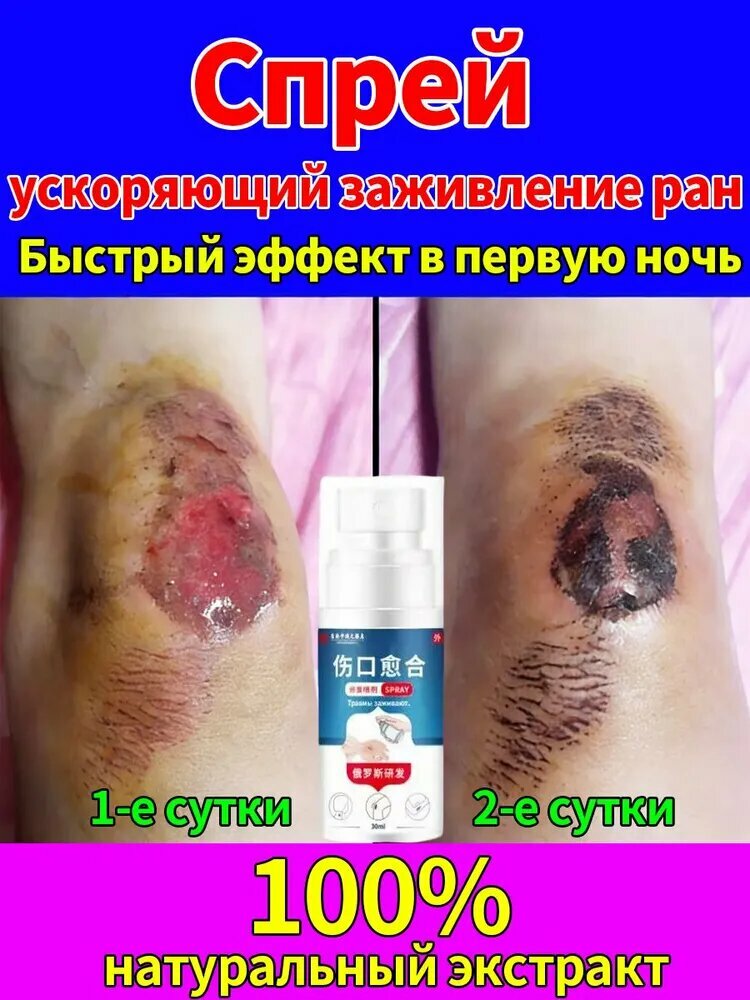 Спрей для лечения диабетической стопы и пролежней: заживление ран и регенерация кожи при сахарном диабете