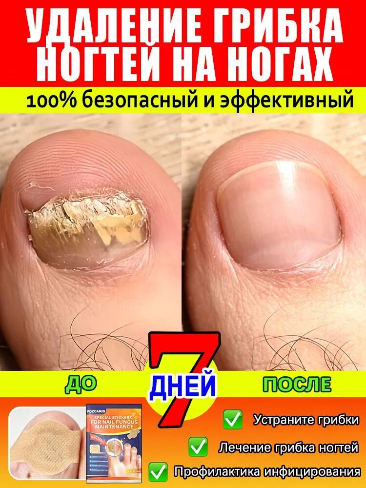 Противогрибковые пластыри для ногтей от грибка ногтей и онихомикоза, удаление поражённой пластины, 21 шт