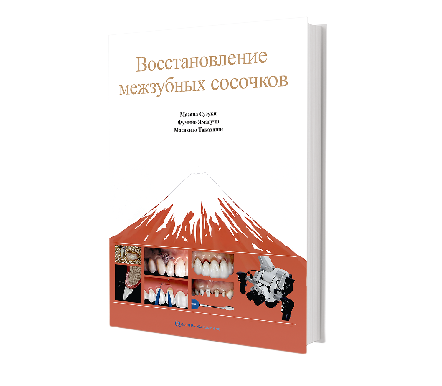 Восстановление межзубных сосочков