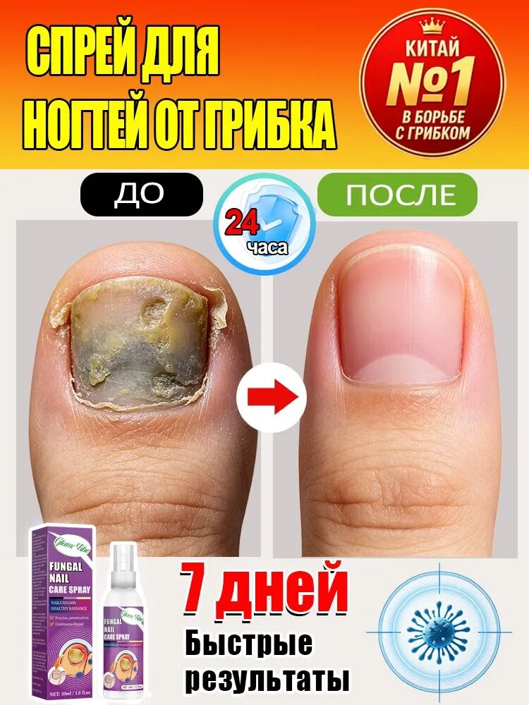 1 флакон 30 мл. Удаляет грибок ногтей на руках и ногах, подавляет рост грибка и способствует здоровому росту ногтей.