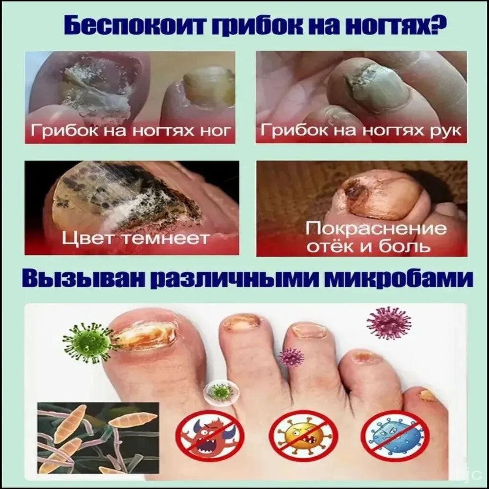 2 штуки, крем ноготок от грибка ногтей на ногах, ноготок мазь от грибка на ногах, гиперкератоз