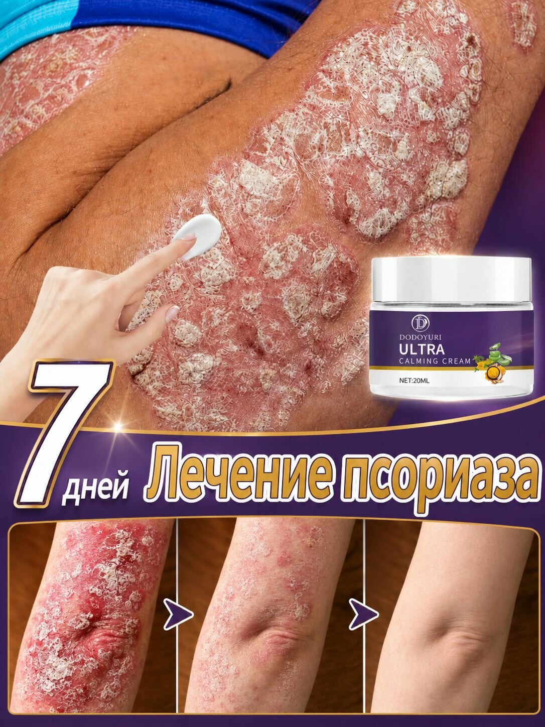 DODOYURI крем от псориаза 20 г, мазь от псориаза, от зуда, сухости и шелушения кожи