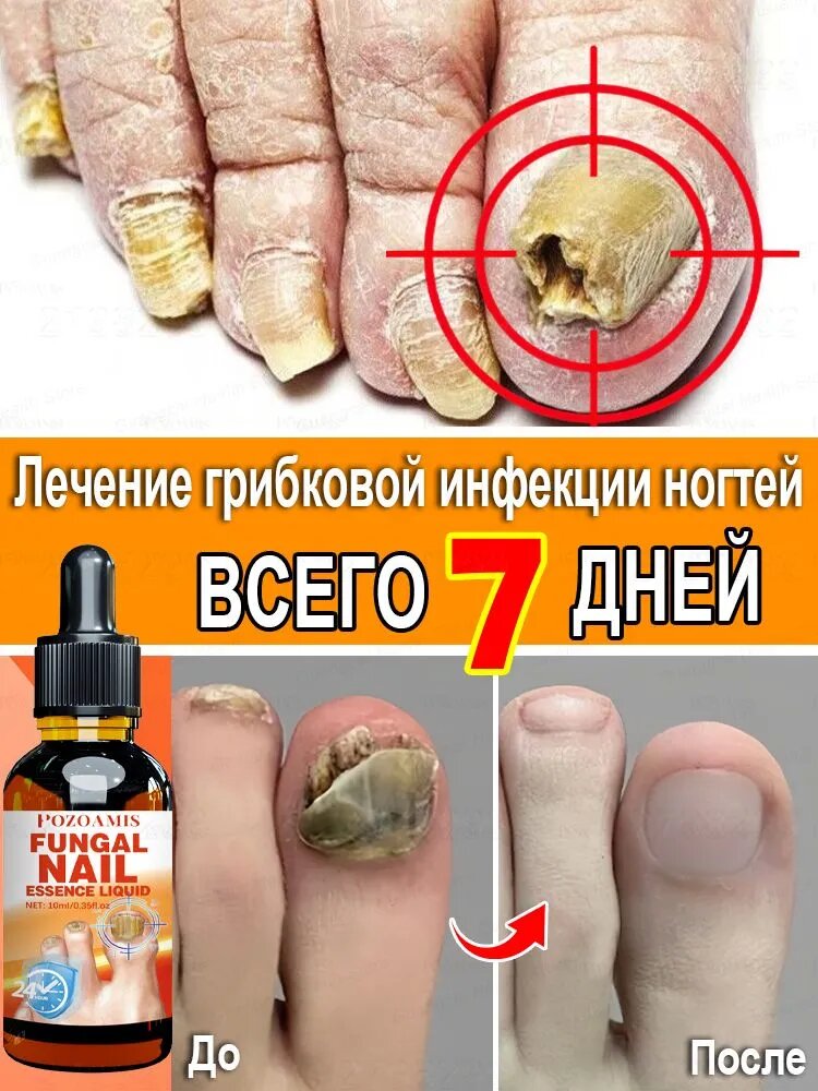Средство от грибка ногтей на ногах и руках, сыворотка Стоп онихолизис ногтей лечение и укрепление восстановления и роста, 10 мл