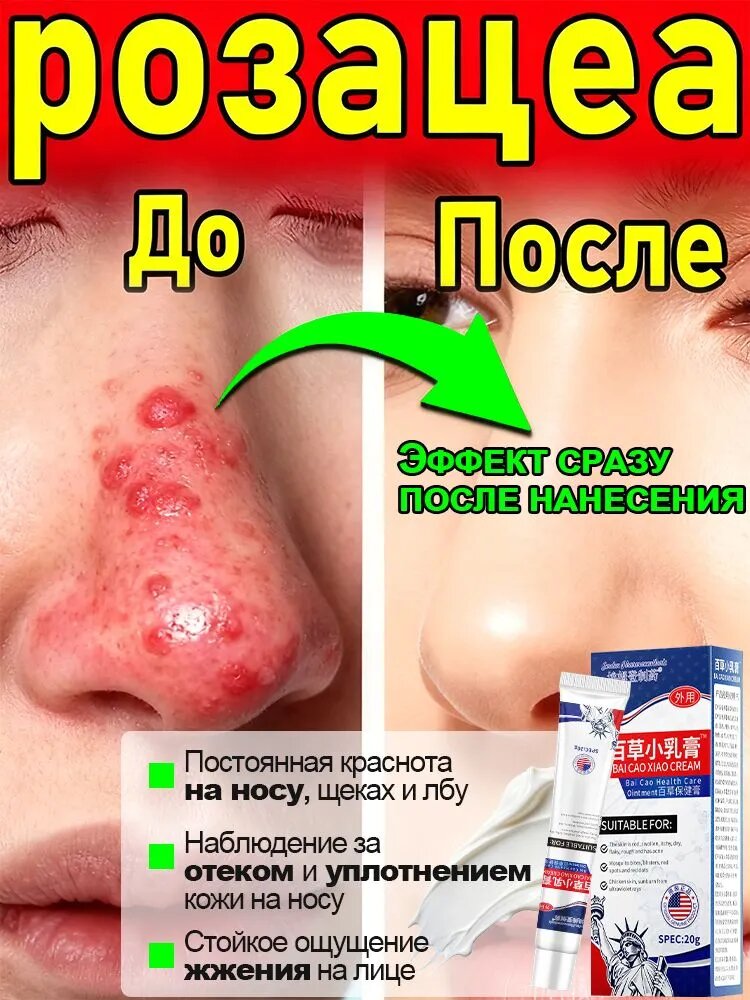 Mазь для лица от купероза, покраснения, прыщей, акне, розацеа, Укрепление барьера, снятие воспаления , устранение зуда и красноты20 г.