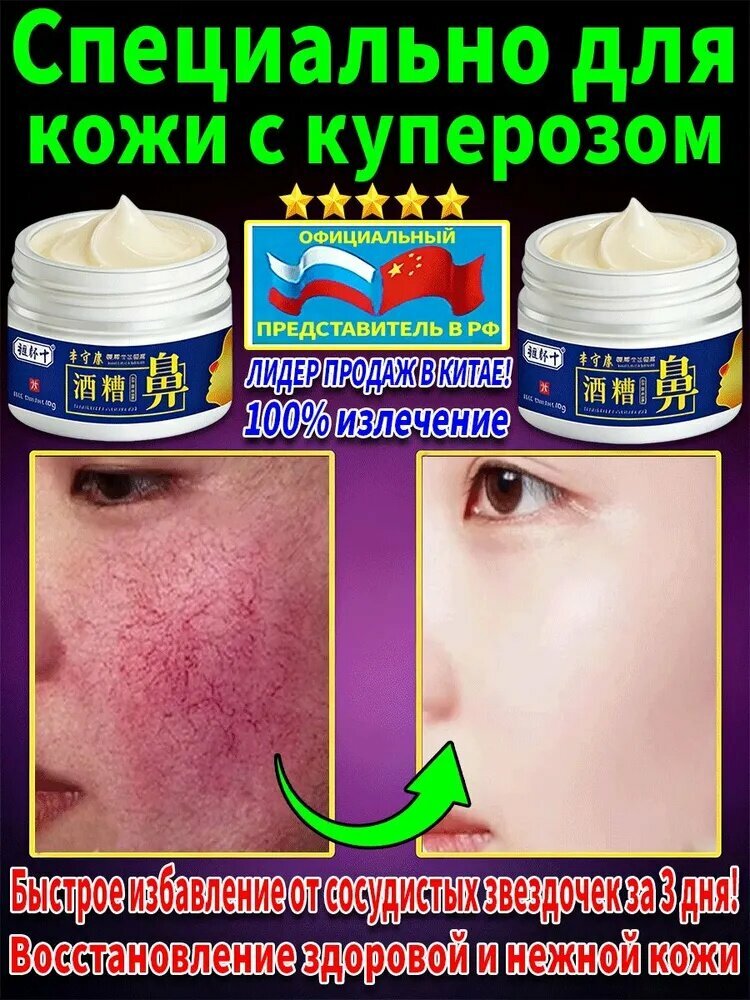Крем для лица от розацеа, покраснения на лице и Купероза купероза против средство сосудистых звездочек, покраснений, китайская чудо-мазь.