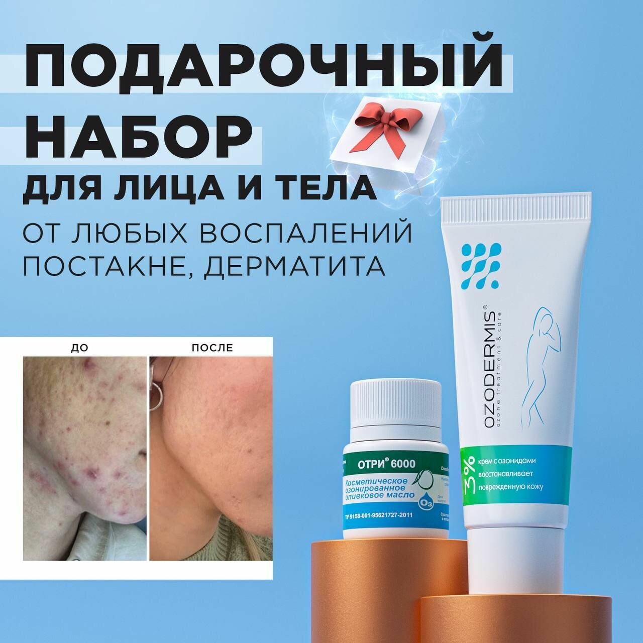 Подарочный набор для ухода за проблемной кожей "STOP ACNE BOX" : Крем для лица и тела Озодермис и озонированное оливковое масло. От акне, дерматита и купероза