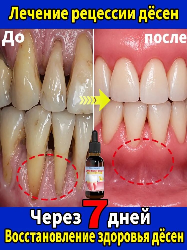 Эфирное масло для полости рта: Эффективно лечит рецессию десен, пародонтит, воспаление и кровоточивость десен; мощное антибактериальное действие устраняет неприятный запах изо рта.150 мл