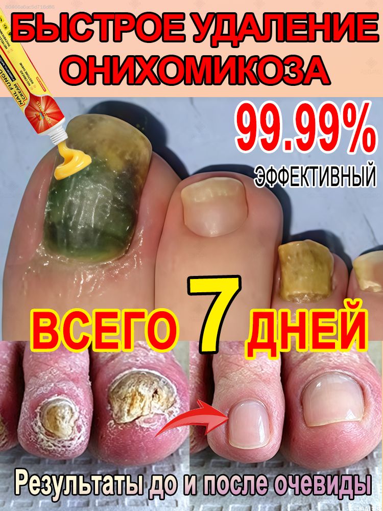Мазь от грибка ногтей с активными натуральными компонентами, быстро проникает в ногтевую пластину, устраняет неприятный запах и зуд, возвращает ногтям здоровый цвет и блеск, 30 мл