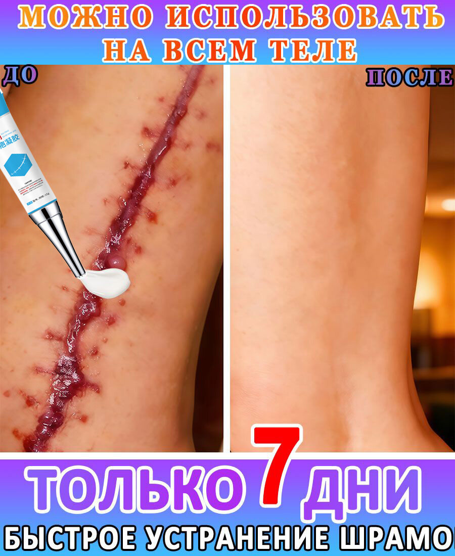 Крем для удаления шрамов. Быстро удаляет шрамы, растяжки, ожоги, рубцы от угревой сыпи и пигментацию. Подходит для любой части тела. 15 грамм.