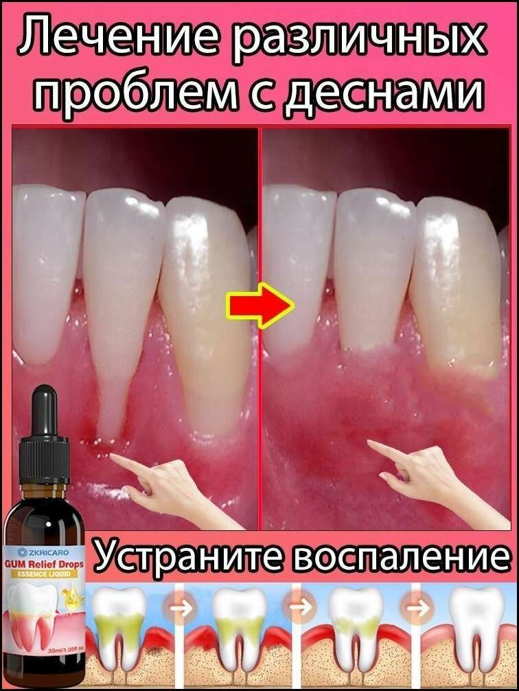 Используется для лечения пародонтита, стоматита, снятия чувствительности и отека десен, восстановления, профилактики и укрепления поврежденных десен, Гигиена полости рта.30 мл.