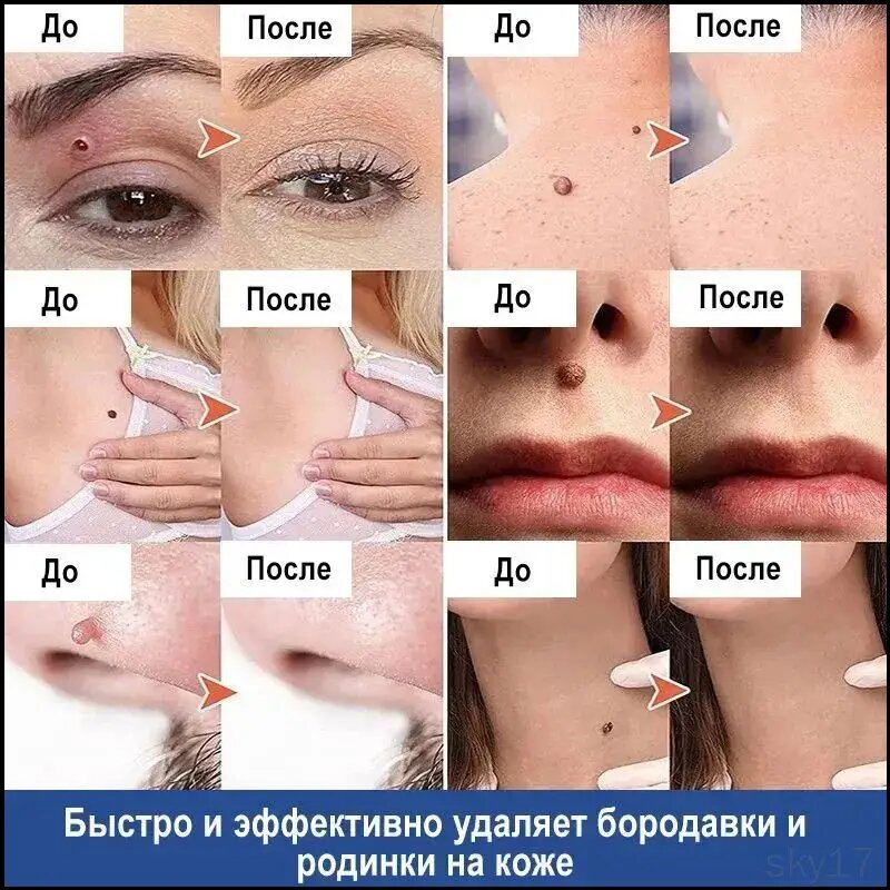 Папилофаг средство от папиллом и бородавок средство от папиллом и бородавок средство бородавок, кондилом, ороговевшей кожи 20 г