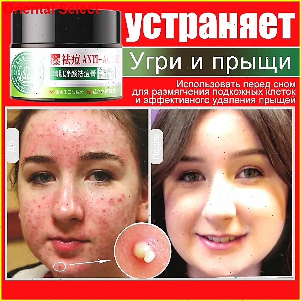 Цинковый крем, Гель от прыщей, прыщей, акне, постакне для наружного применения. Мазь цинковая от прыщей увлажняющая, точечное средство для подростков и взрослых 30 г.