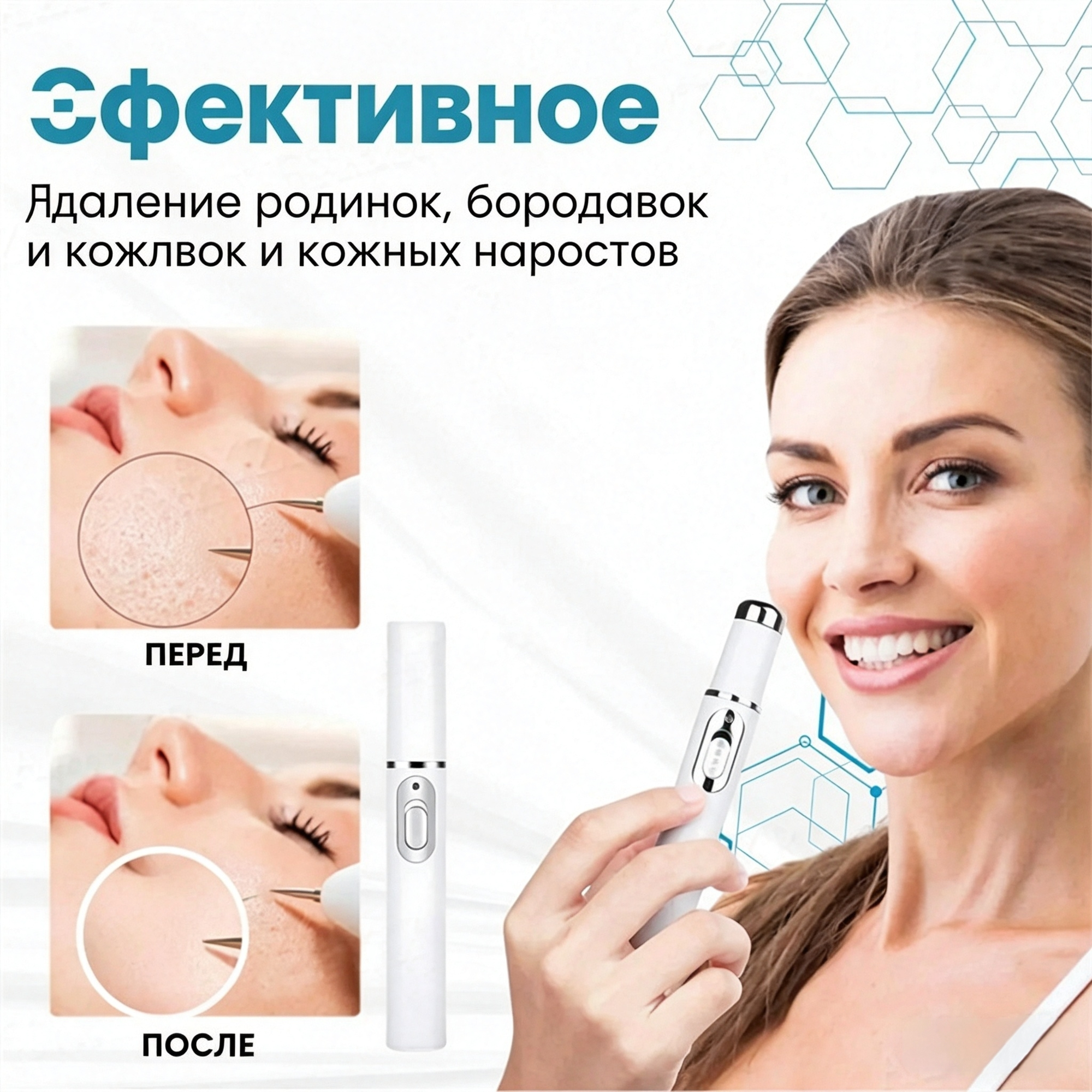 Лазерная ручка для удаления родинок, Синяя световая ручка для лечения акне, Портативный.
