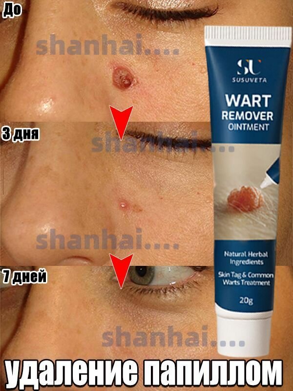 SUSUVETA / Мазь от бородавок, Крем средство для удаления бородавок, папиллом и родинок, безболезненно, не оставляет следов без побочных эффектов / 20г