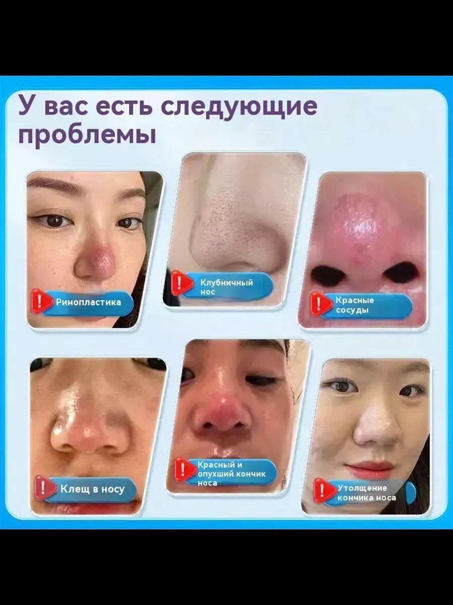 Крем для лица от купероза, розацеа, покраснений "Тонус-Капилляр Лица". для проблемной кожи,100% натуральный В безгормональном составе.20 мл