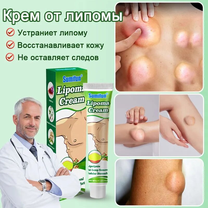 Мазь от липом и жировиков, акне, фурункулеза, быстро удаляет подкожные жировые опухоли 20 г