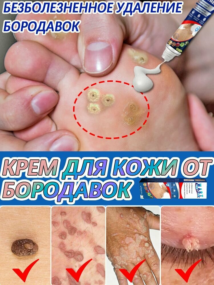 Универсальный крем для удаления бородавок всех видов от папиллом до подошвенных и генитальных. Быстро, эффективно и без раздражения на любом участке тела.3 упаковка