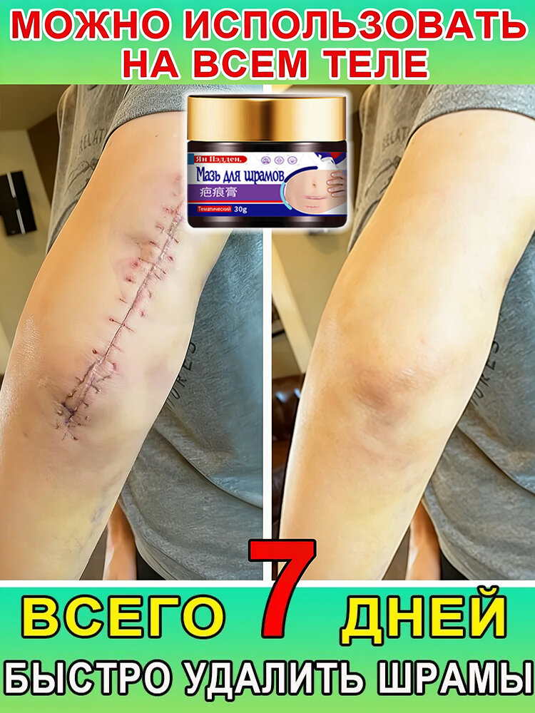 Гель от шрамов и рубцов / От постакне, крем от растяжек, от ожогов, на силиконовой основе