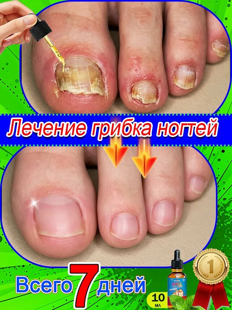 Масло от грибка ногтей быстрое действие за неделю устраняет желтизну утолщение и трещины восстанавливает здоровые ногти без подпиливания.10 мл