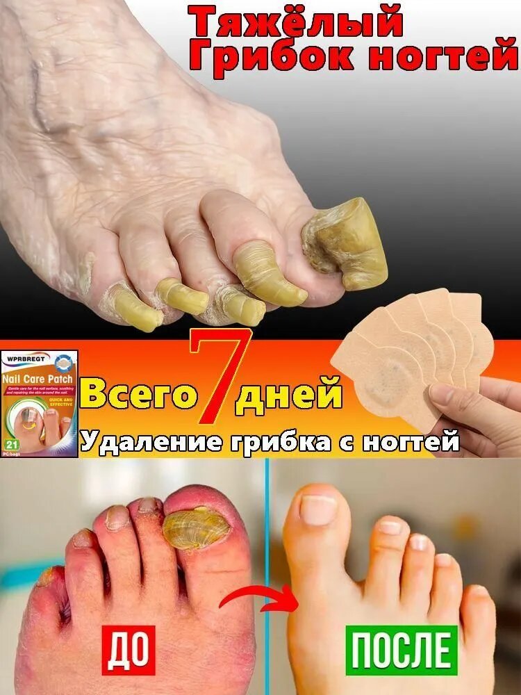 Пластыри от грибка ногтей, лечение онихомикоза, восстановление и защита ногтей, против грибка, 21 шт