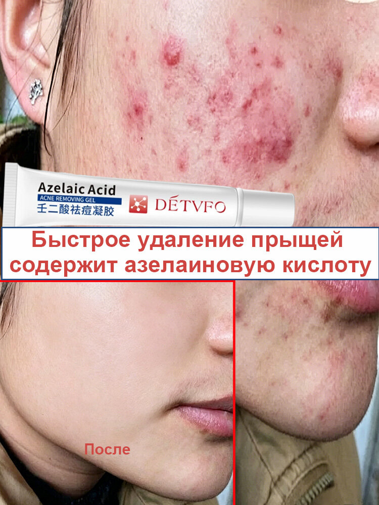 Крем от прыщей на лице