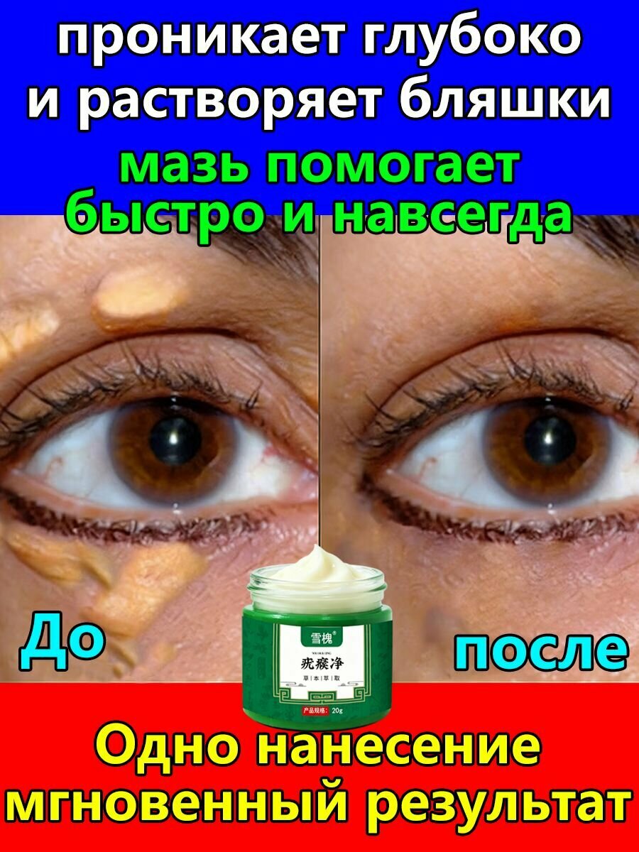 Мазь от ксантелазмы и ксантом на веках и лице. Лечение папул и желтых бляшек вокруг глаз. Эффективное средство против атеромы