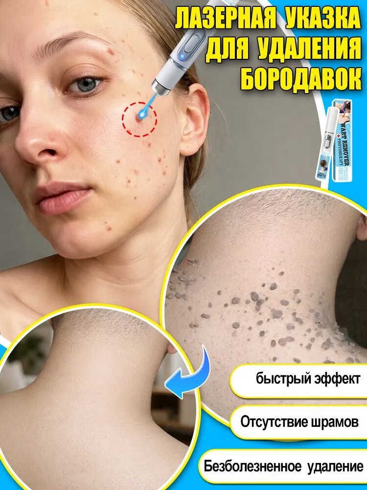Лазерный карандаш для удаления папиллом и бородавок, прибор для ухода за кожей, точечное воздействие, быстрый результат, без боли, 1 шт