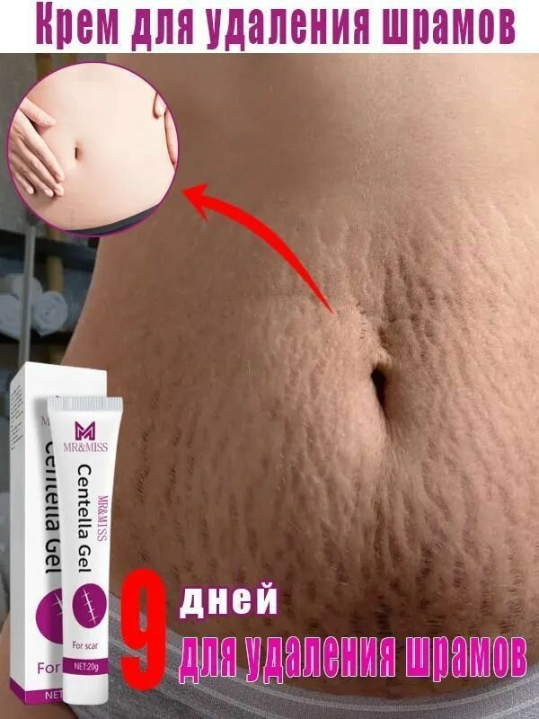 Средство от растяжек