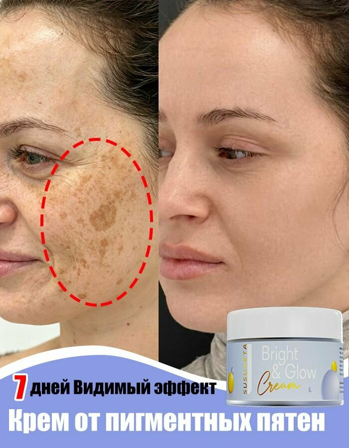 Отбеливающий крем от пигментных пятен и веснушек, против пигментации, Удаление мелазмы и пигментных пятен, Коррекция тона кожи 30г