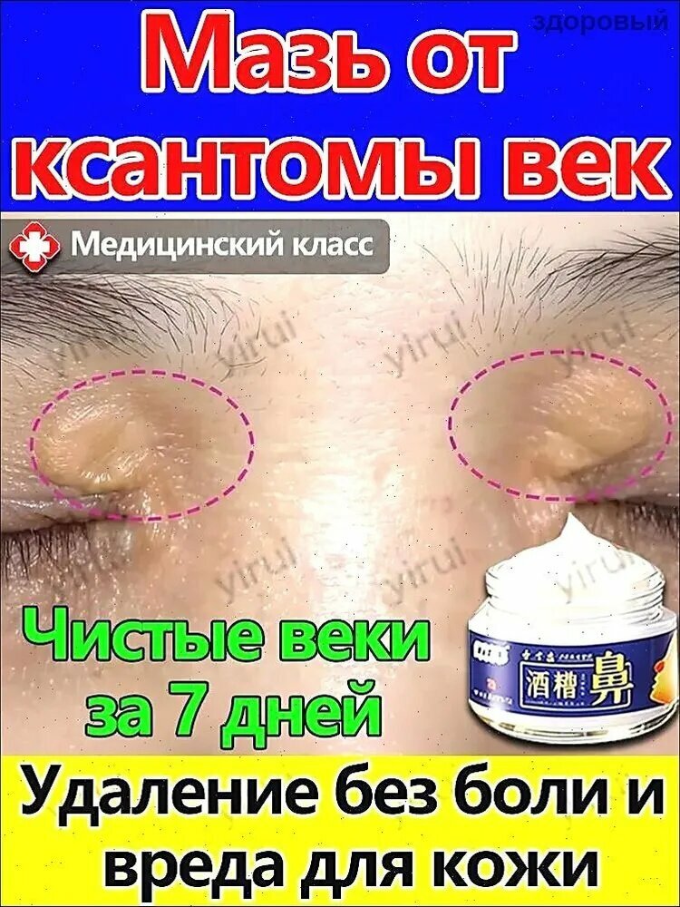 Мазь от ксантелазмы и ксантом на веках и лице. Лечение папул и желтых бляшек вокруг глаз. Эффективное средств