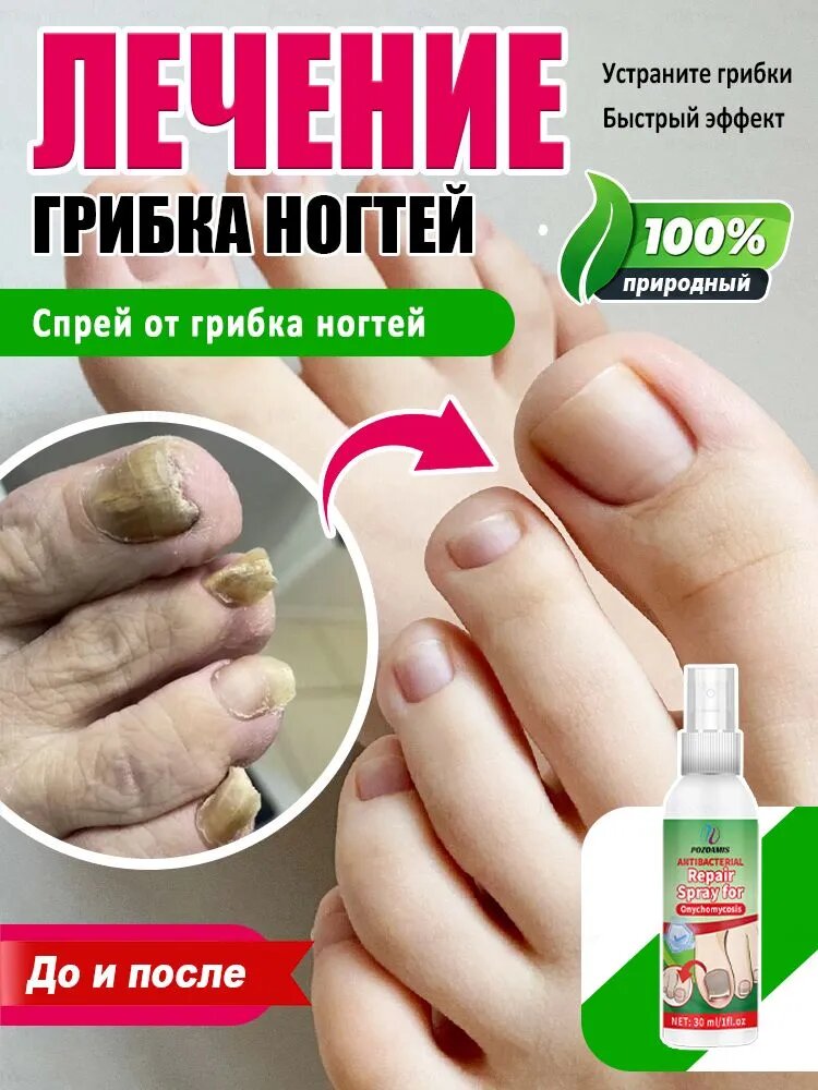 1 флакон 30 мл. Полностью излечивает онихомикоз рук и ног, подавляет рост грибков и способствует здоровому росту ногтей.