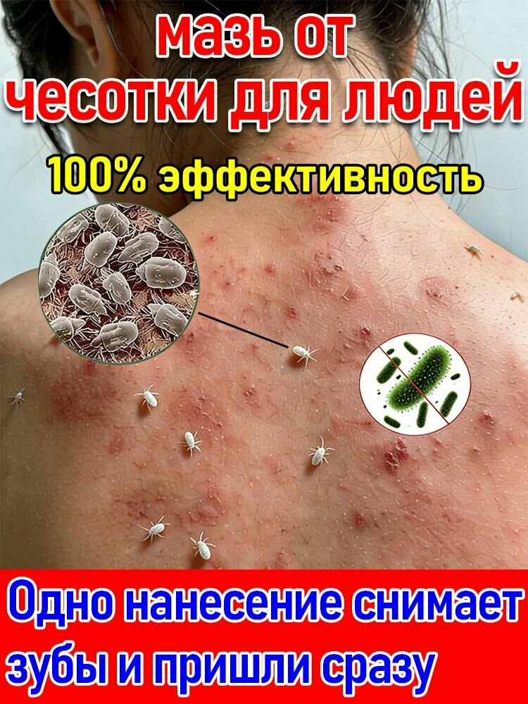 Специальная мазь от демодекоза чесотка для спины