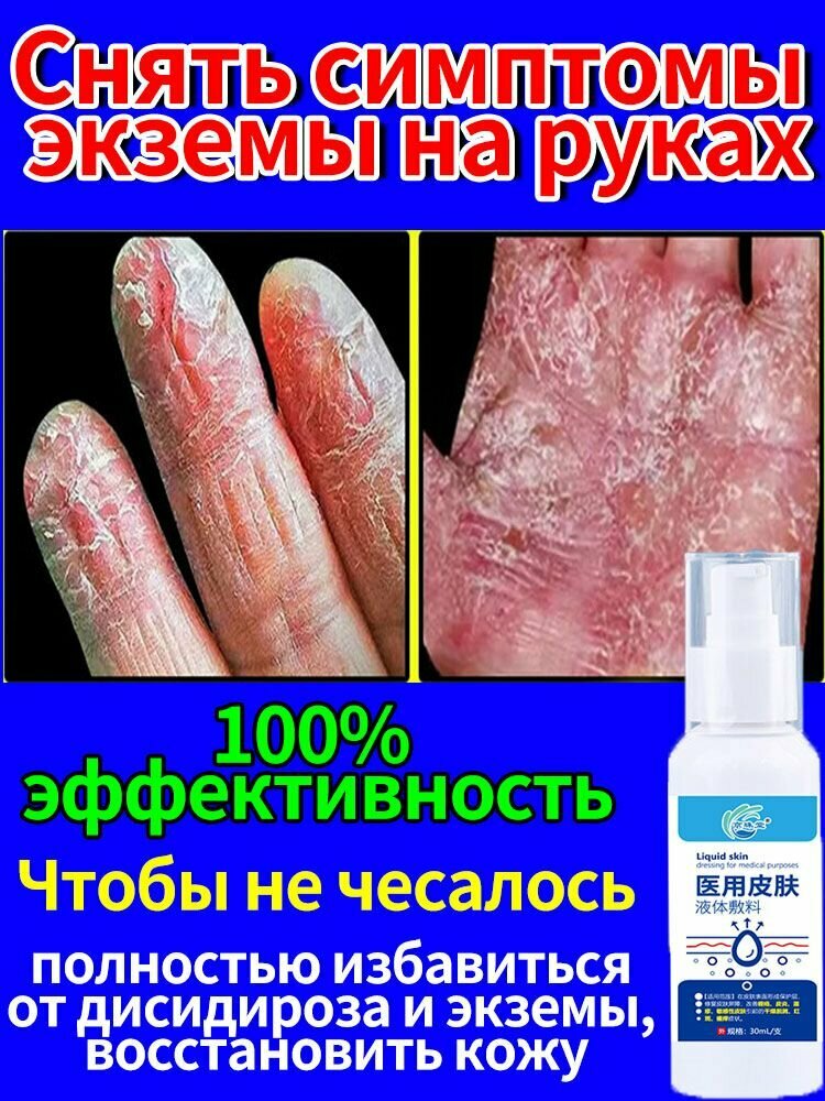 Мазь против зуда, подходит для лечения псориаза, экземы, нейродермита, грибковых инфекций, дерматита и себорейного дерматита