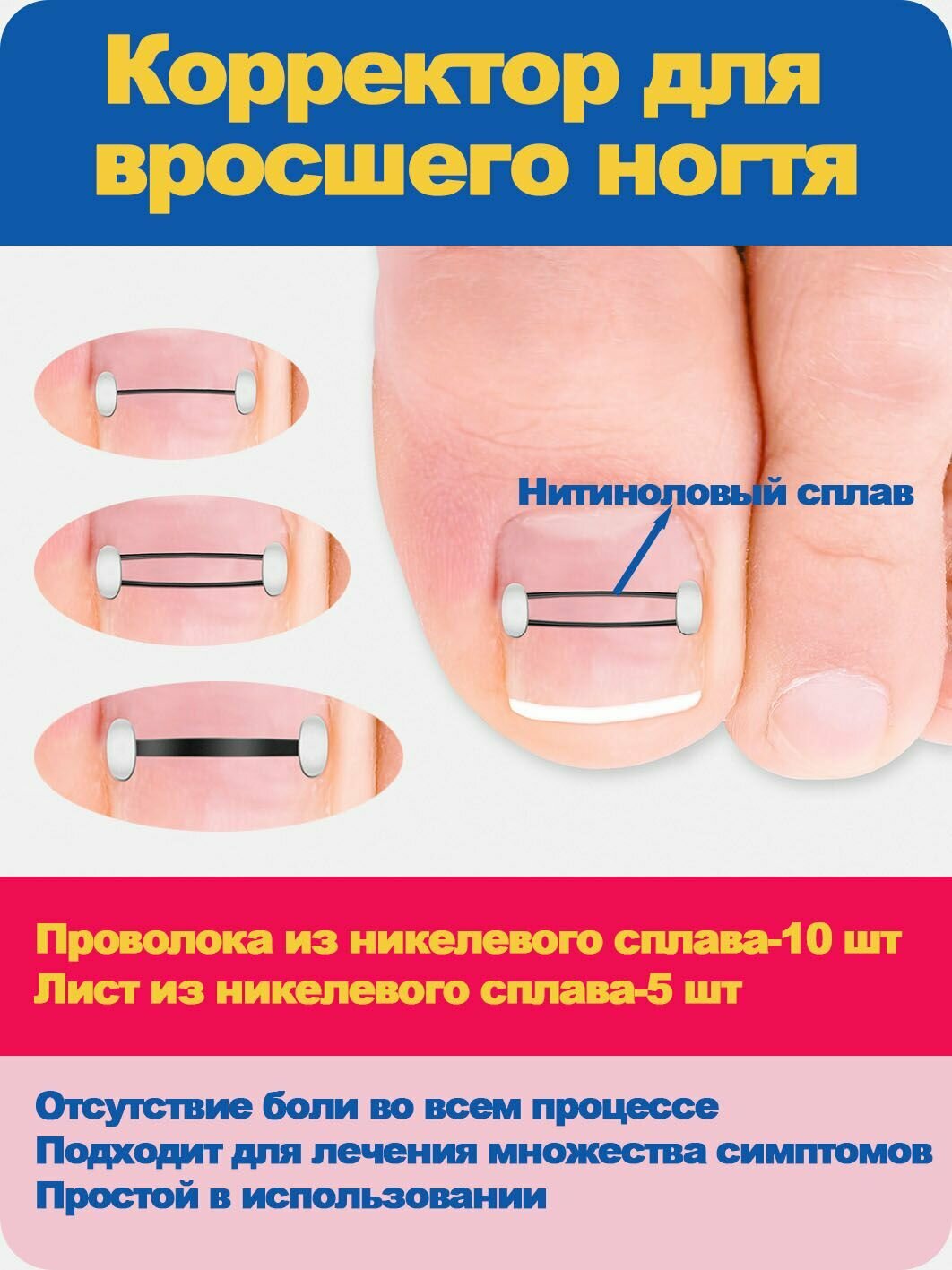 Комплект из 10+5 никелид-титановых корректоров для вросших ногтей